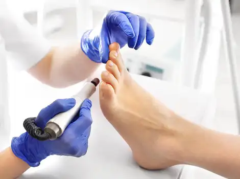 Remedios caseros como sacar un uñero del pie sin dolor, trucos caseros ...