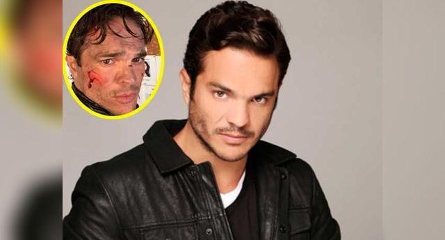 Kuno Becker: ¿actor mexicano perderá la visión tras accidente? (FOTOS ...