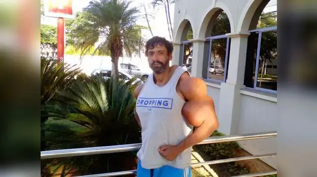 Brasil: Hombre se inyecta aceite para ser como el Increíble Hulk (FOTOS ...